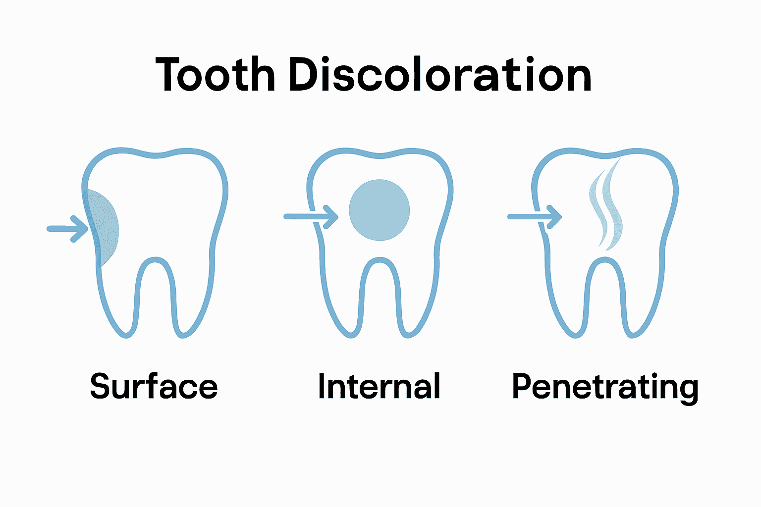 The Essential Guide to Tooth Discoloration Causes | Paynless